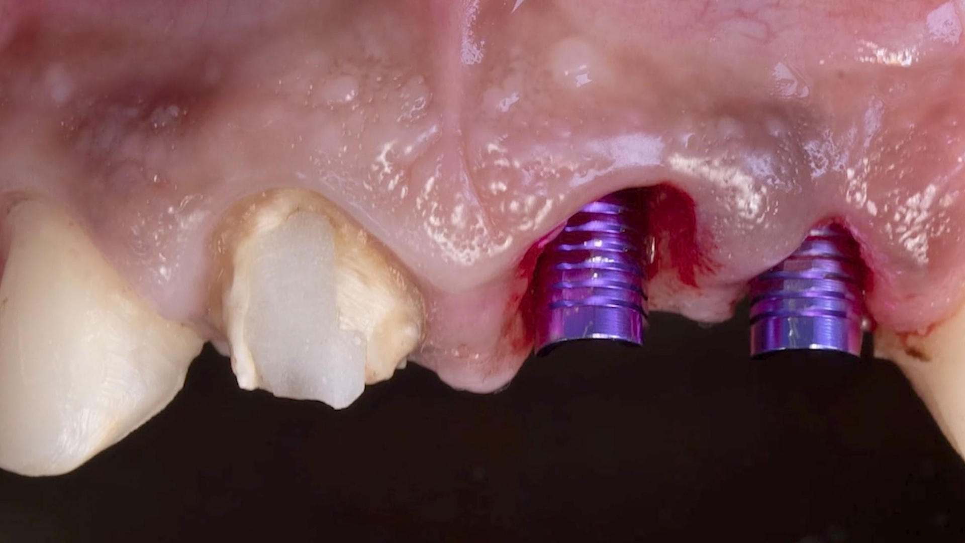 Ice Cream Cone Technique: cos’è, come e quando eseguirla